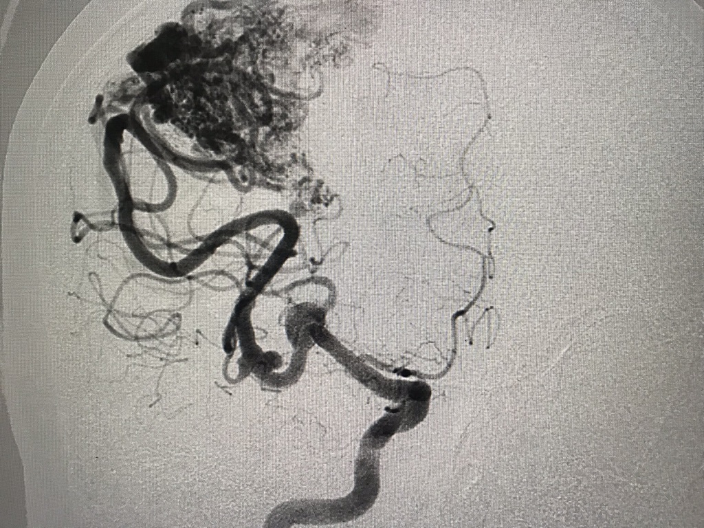 Vascular Malformations/Dural Arteriovenous Fistulas - Dr. Alexander L. Coon